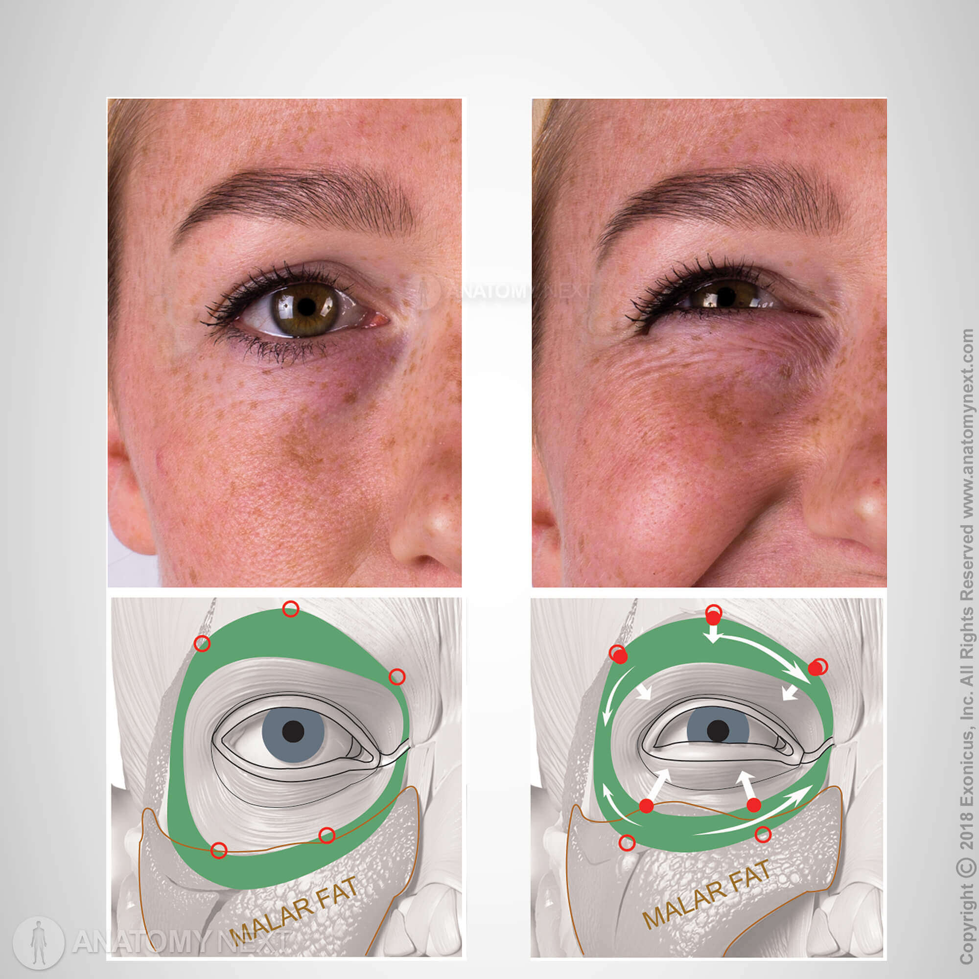 Reconstruction Of Eye Closure And Blinking Reflex Fazialis